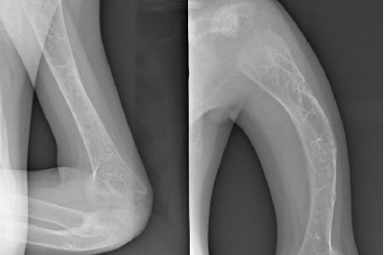 Pessoas Com Osteogenese Imperfeita Saiba Mais Sobre Osteogenes